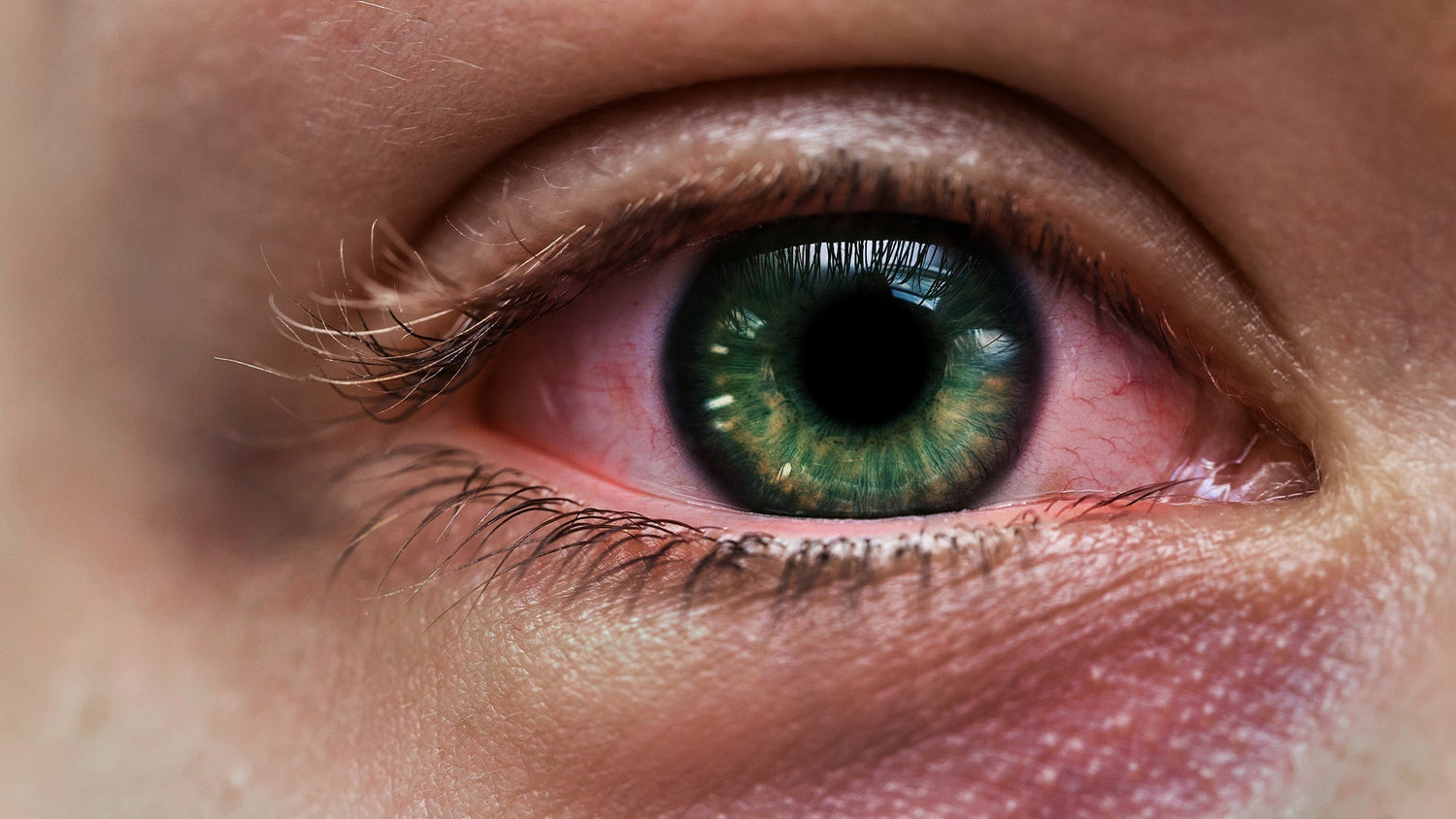 Can Contact Lenses Cause Pink Eye? Symptoms, Prevention, and Treatment ...